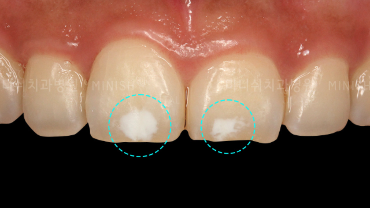 What Are The White Spots On My Teeth After Whitening Toothpaste ...