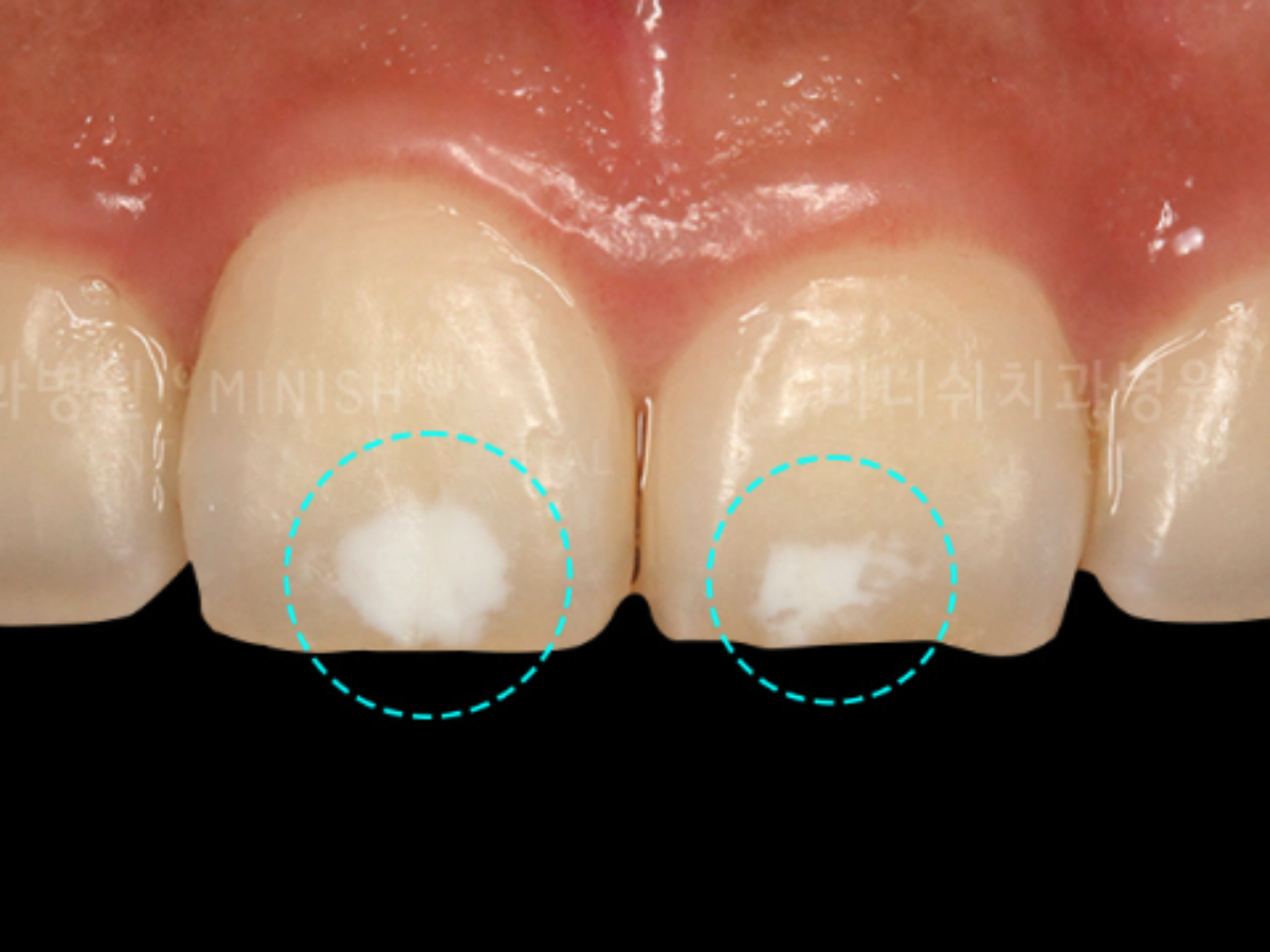 Why Do I Have White Spots On My Teeth After Bleaching - Infoupdate.org