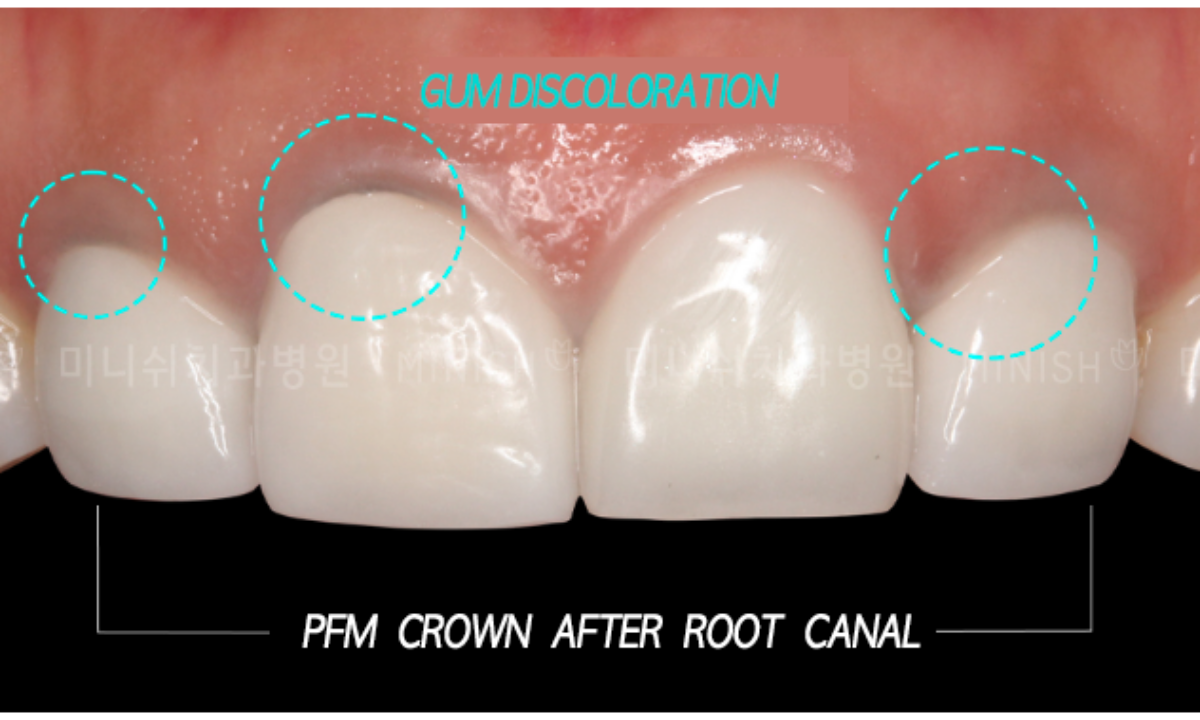 How Long Will My Gums Be Swollen After Root Canal And Crown ...